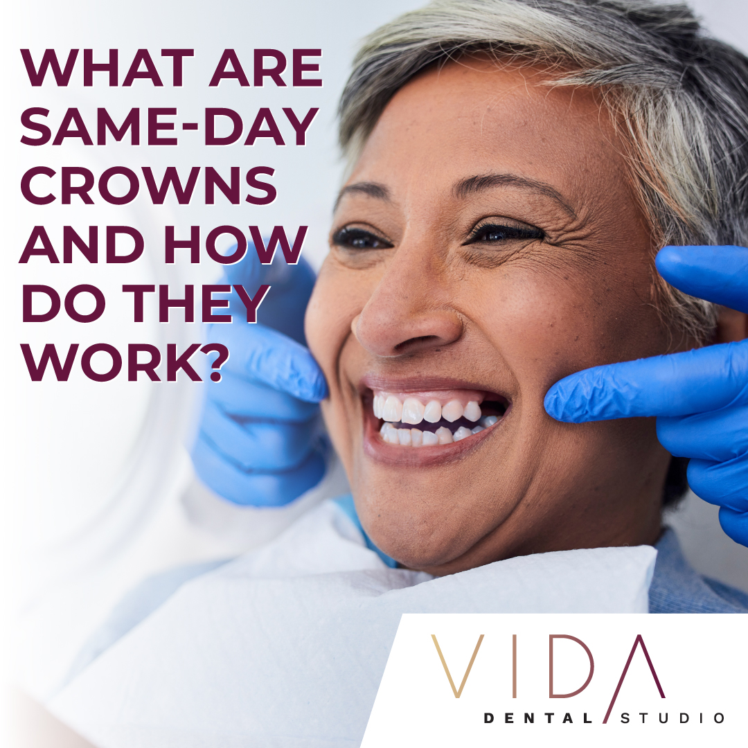 What Are Same-Day Crowns and How Do They Work in Santa Fe, NM? | Vida Dental Studio